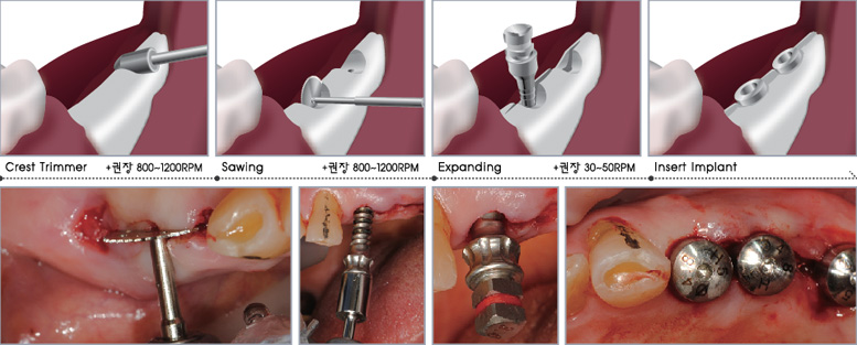 BONE EXPANDER KIT | DENTAL STUDIO
